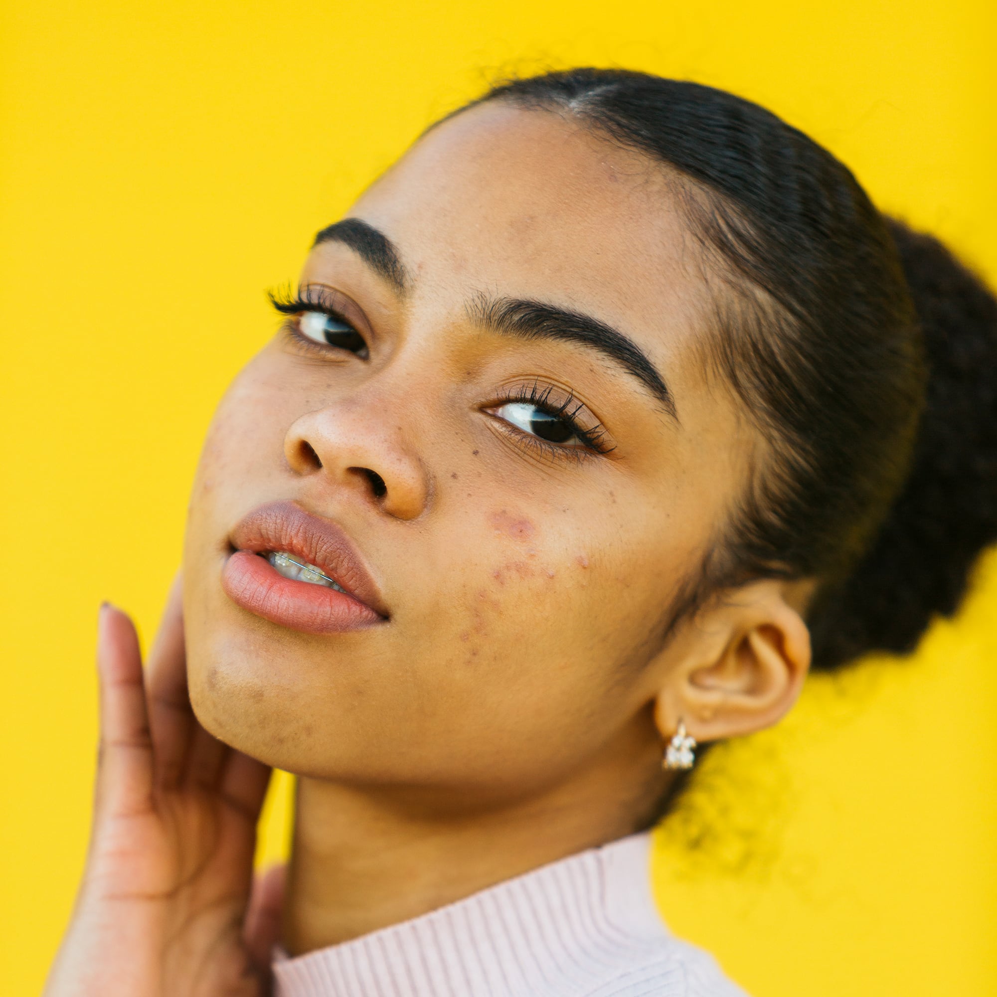 Pretty Girl With Acne Scars